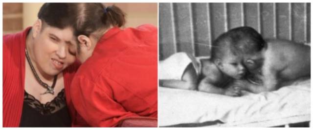 I gemelli siamesi più vecchi del mondo sono morti a 62 anni negli Usa ...